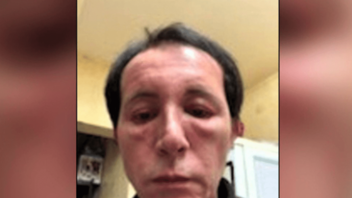 Jugement de deux sœurs pour injections illégales de botox, Valenciennes ...